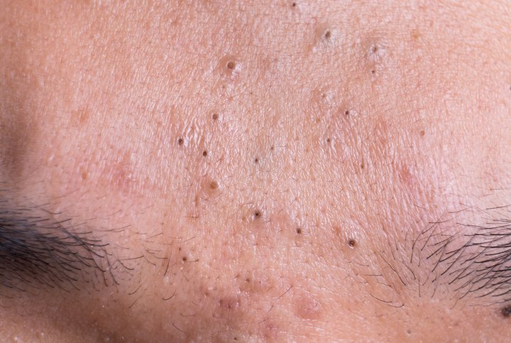 How To Get Rid Of Blackheads: 6 Safe And Gentle Solutions – Bare Skin Care by Dr. Bollmann