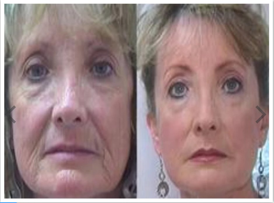 Wrinkles Unveiled: Identifying the Culprits Behind Aging - Bare Skin ...